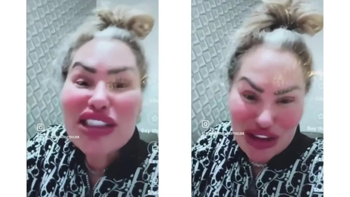 Darcey Silva’s Sparks Concern and Outrage Over BOTCHED Face Transplant ...