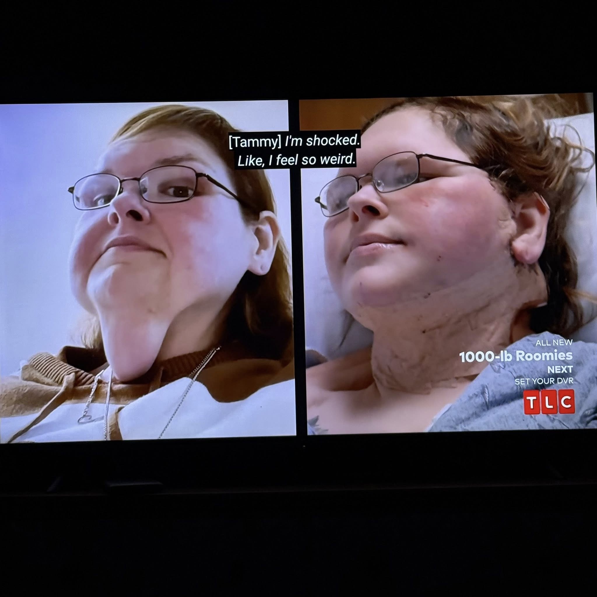 Tammy Gets A Facelift Along With Skin Removal Surgery. – Daily News